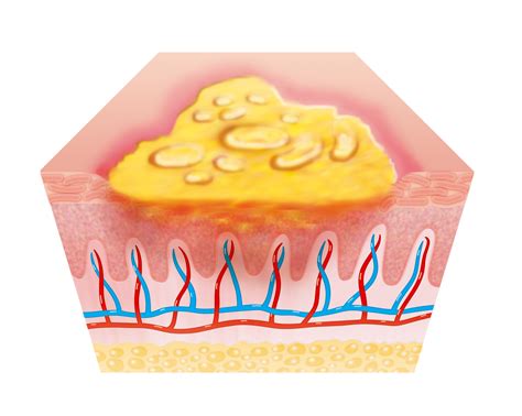 Wound Types Trigocare