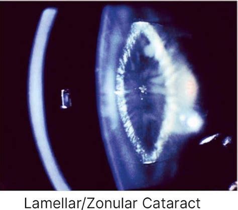 Coronary Cataract