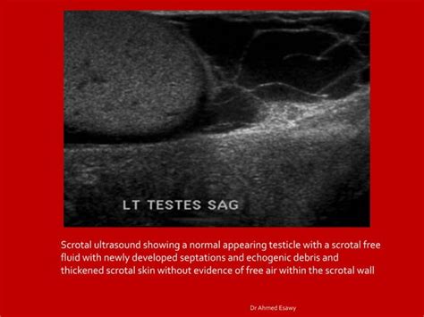 Imaging Orchitis Epidydmitis Epidydmo Orchitis Drahmed Esawy Pdf
