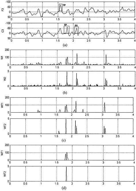 Results Illustrating A Detection Of Spikes For Patient 5 In Channels Download Scientific