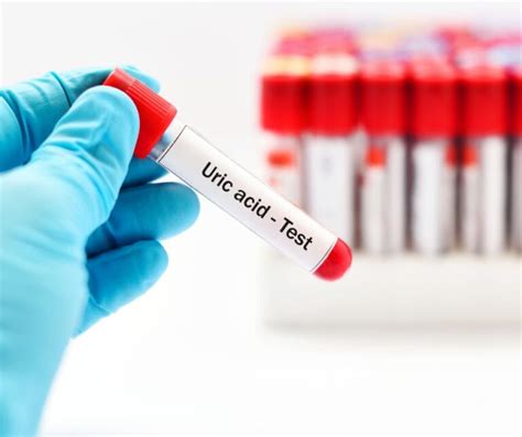 Uric Acid Normal Range In Males And Female