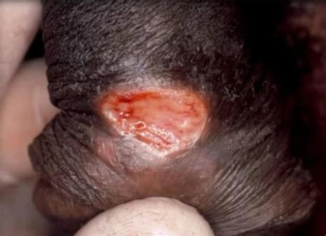 Pictures Of Syphilis In Men And Women Std Testing Near Me
