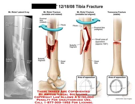 Tibia Fracture