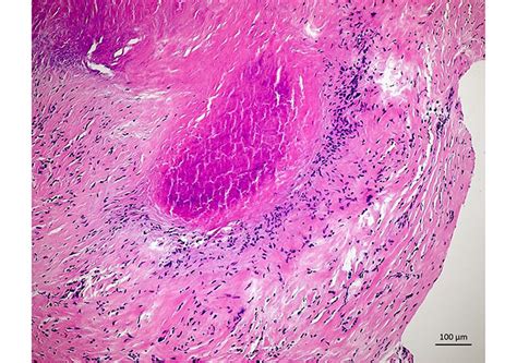 Tophus Pathology Outlines