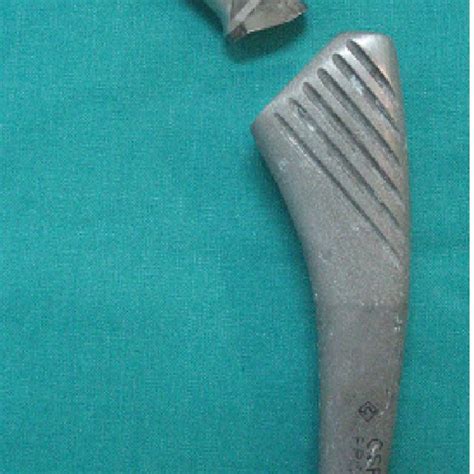 Photograph Of The Retrieved Fully Modular Prosthesis Showing The