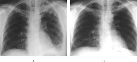 Figure 1 From Left Lumbar Subcutaneous Cold Abscess With Tuberculous