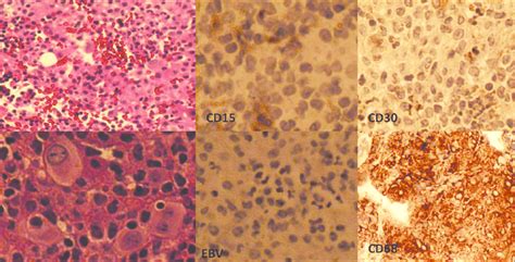 Frankly Hemorrhagic Pleural Fluid Aspirated Cytology Showing