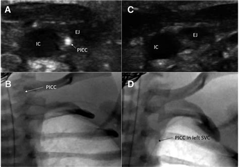 Real Time Point Of Care Ultrasound Guided Correction Of Picc Line