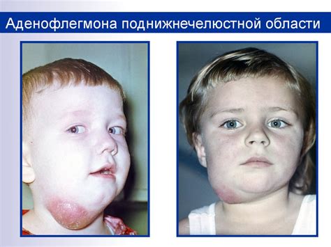 Воспалительные заболевания челюстно лицевой области у детей Особенности их лечения Лимфадениты