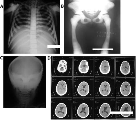 X Rays And Computed Tomography Scan Image Of The Patient Showing Bone Download Scientific
