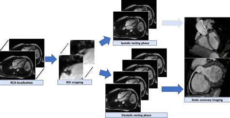 Figure 1 From Automated Cardiac Resting Phase Detection Targeted On The