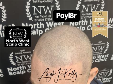 Gallery - North West Scalp Clinic