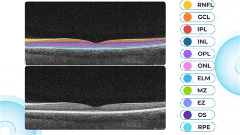 Oct Scan Normal Eye Vs 8 Most Common Pathologies