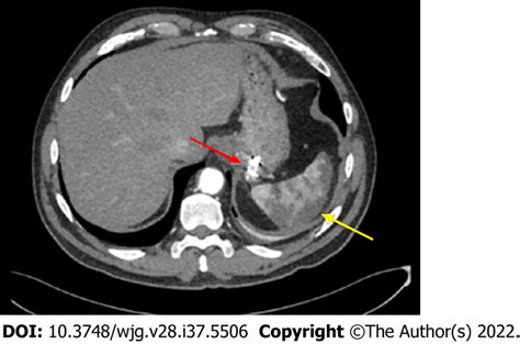 Post Operative Computed Tomography Angiography Axial View Showing Download Scientific Diagram