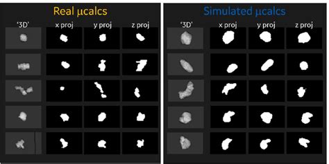 examples of real microcalcifications and newly generated download