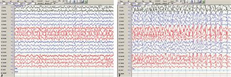 Continuous Electroencephalogram Segments For Case 2 Showing A Right Download Scientific