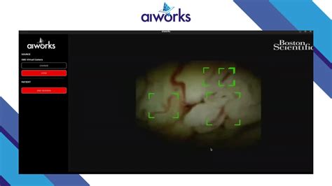 [video] Endorx On Linkedin Medicalinnovation Artificialintelligence Cholangioscopy