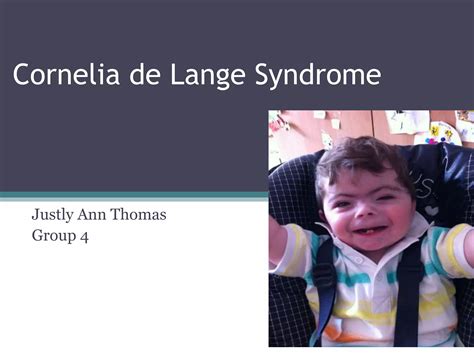 Cornelia De Lange Syndromepptx