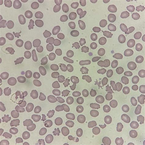 Acanthocytes Spur Cells Mls Hematology Bench Guide Medlabbuddy