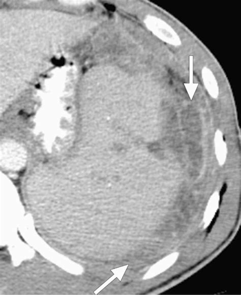 Cross Sectional Imaging Findings Of Splenic Infections Is Differential