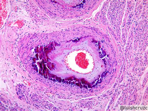 Monckeberg Arteriosclerosis