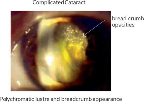 Guide To Cataracts Types Causes Treatment And More