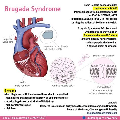 Brugada Syndrome” A Silent And Deadly Threat To Thai Men Chulalongkorn University