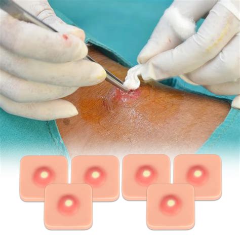 Mua Ultrassist Abscess Iandd Incision And Drainage Pad 6 Pack