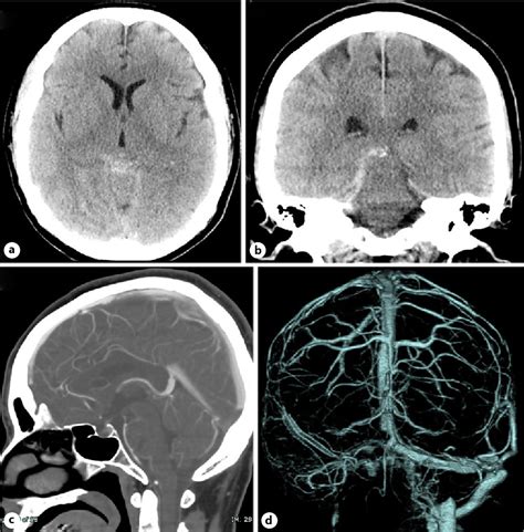 Figure 1 From A Case Of Perimesencephalic Subarachnoid Hemorrhage With Cerebral Venous Sinus