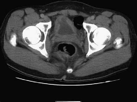 Computed Tomography Showing Irregular Bladder Outline With