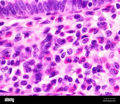 Light Microscope Micrograph Showing Eosinophil Granulocytes In The
