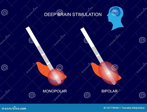 Deep Brain Stimulation For Treatment Of Parkinson Disease Vector