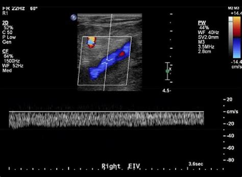 Best Describe Spontaneous And Phasic Flow In A Vein