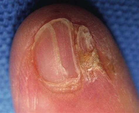 Nail Dystrophy Definition Causes And Treatment