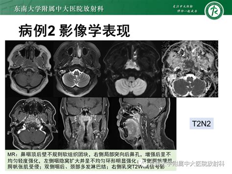 【ppt】鼻咽癌影像及分期 影像ppt