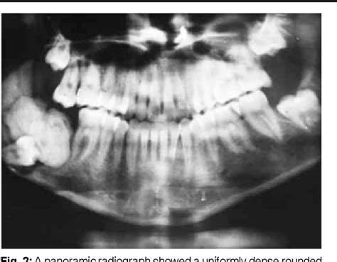 Figure 1 From Complex Odontoma Intraosseous Type Associated With Mandibular Impacted Permanent