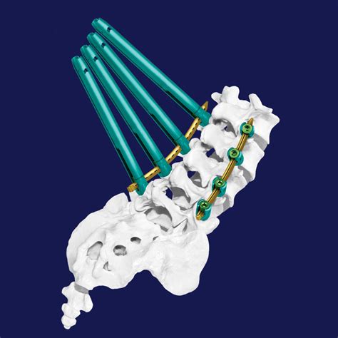 Mis Posterior Spine Fixation System Infinitmed