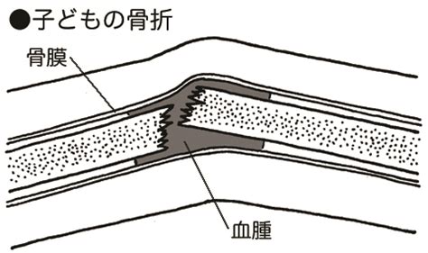 骨折｜子ども医学館｜妊娠・出産・育児に関する総合情報サイト【ベビカム】