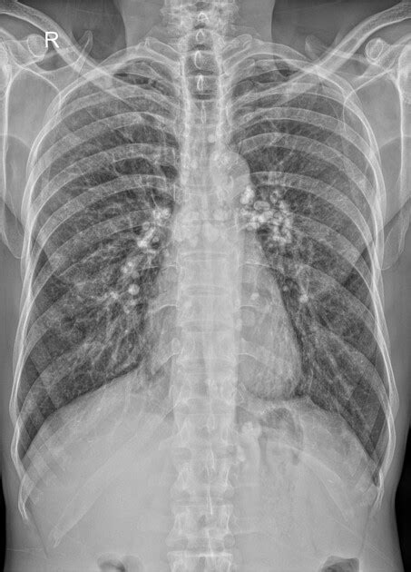 Calcification Of Lymph Nodes