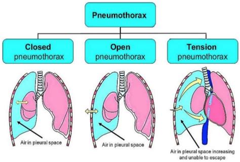 Medical School Tension Pneumothorax What To Do Nursing School Survival Medical School