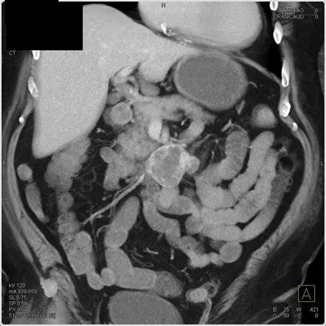 Duodenal Gist Tumor Small Bowel Radiology Case Studies Ctisus Ct