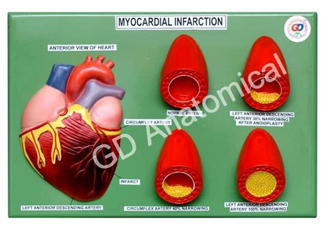 Myocardial Infarction Model