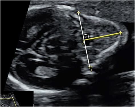 Anteroposterior Mandibular Diameter Apd Measurement Jaw Index