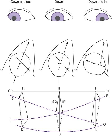 Incomitant Deviations Ento Key