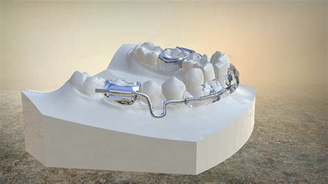 Digital Lip Bumper Appliance 3d Model 3d Printable Cgtrader