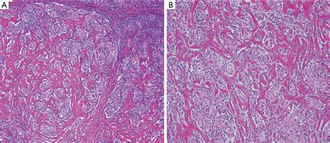 Igg4 Thyroiditis In The Asian Population Pmc