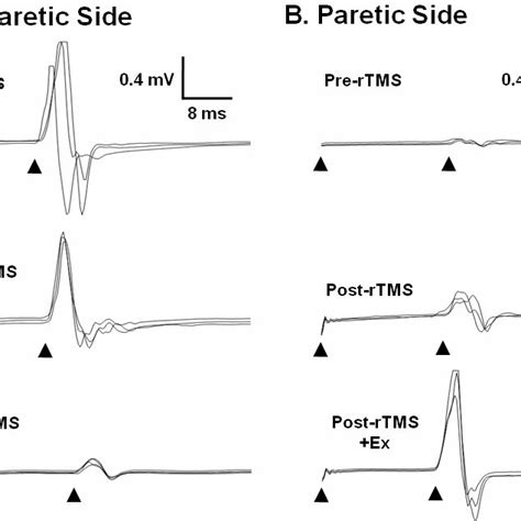 Mep Amplitude And Latency From Both First Dorsal Interosseous Muscles