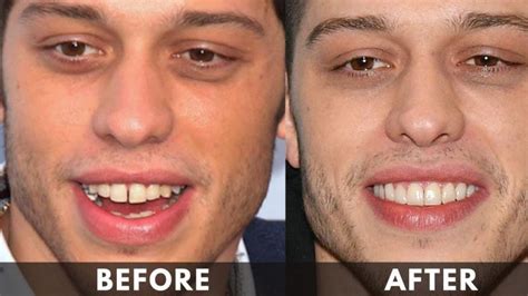 Cardi B Teeth Transformation Surgery Cost Before And After