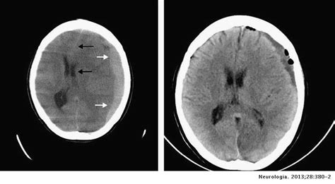 Difference Between Subdural And Epidural