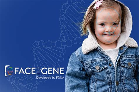Fdna™ Complex Genetic Diseases A Pediatricians View With Face2gene